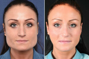 Misaligned Jaw: Symptoms, Causes and its Treatment